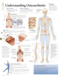 Understanding Osteoarthritis chart: Laminated Wall Chart by Scientific ...