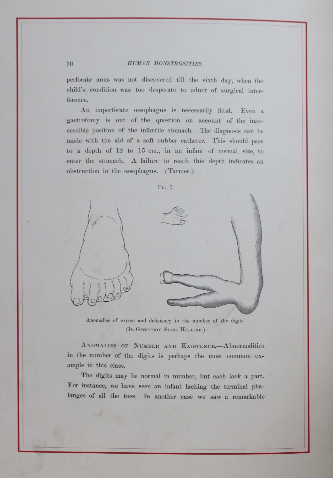 Human Monstrosities by Hirst, Barton Cooke and Piersol, George Arthur ...
