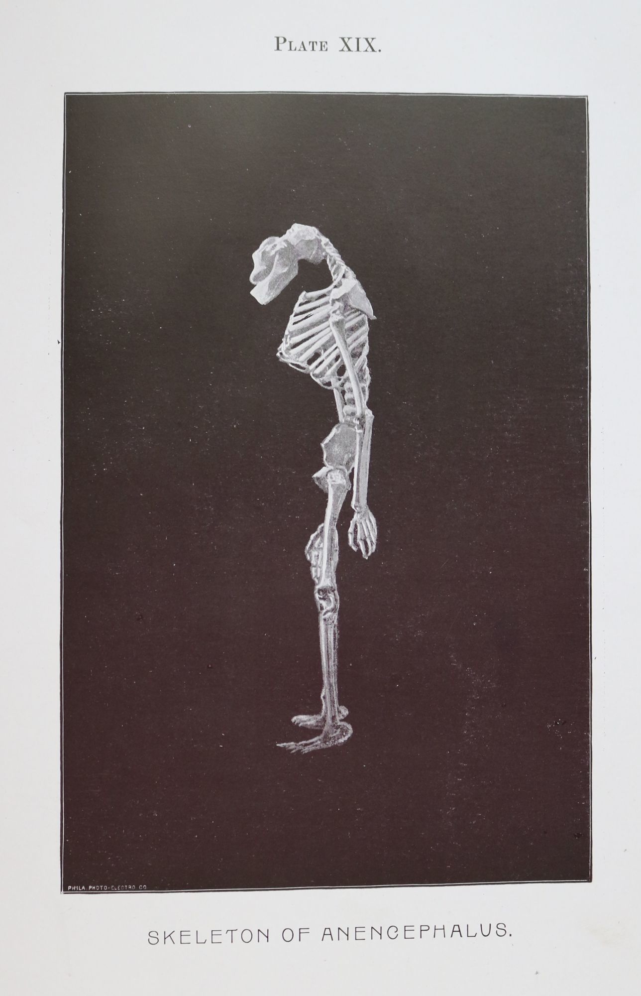 Human Monstrosities by Hirst, Barton Cooke and Piersol, George Arthur ...