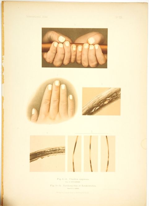 Canities unguium. + Unna, P.G.: Leukonychie und Leukothrichie. by ...