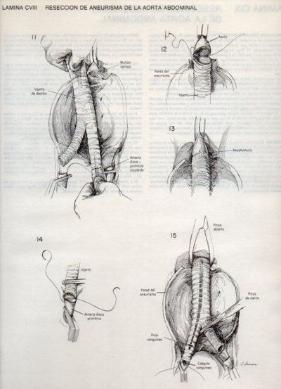 BIBLIO | LAMINA V20169: Reseccion de aneurisma de la aorta abdominal 1 ...