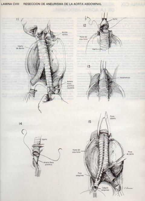 BIBLIO | LAMINA V20169: Reseccion de aneurisma de la aorta abdominal 1 ...